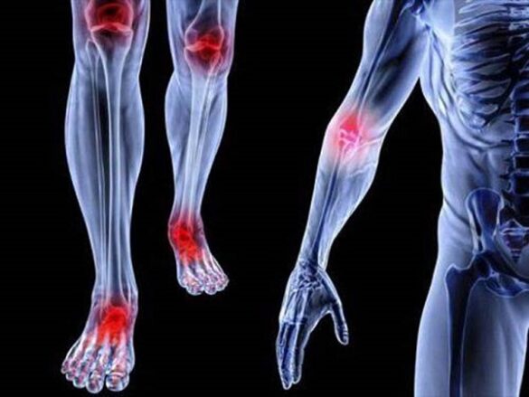 Adult-onset Still's disease - AOSD: Causes, Diagnosis and Treatment ...